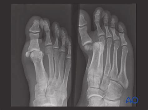 Mtp Joint Dislocation