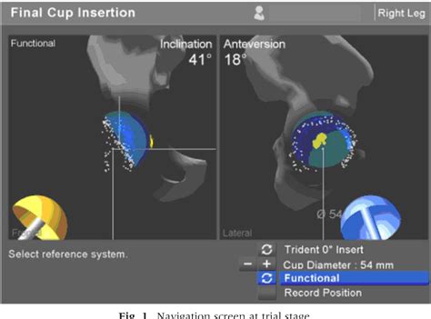 Figure 1 From Comparison Of Cemented Vs Uncemented Acetabular Component Positioning Using An