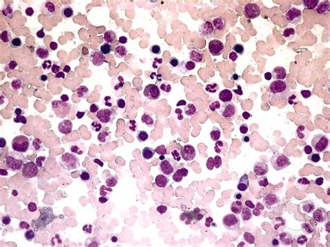 Normal Bone Marrow Aspirate 1