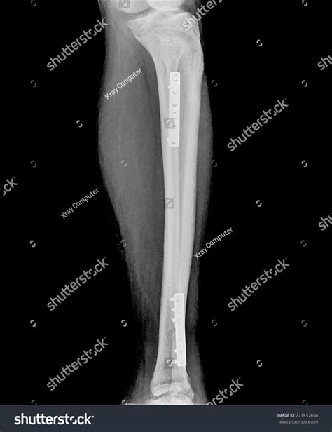 Film Xray Show Fracture Shaft Tibia Stock Photo 221837656 Shutterstock