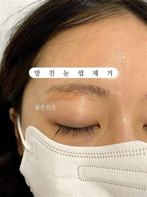 강남눈썹문신 잔흔제거 눈썹문신제거 잔흔제거수강 뷰티해온 기존모와 다르게 그려진 반영구 잔흔입니다 후회로 남은 눈썹문신 뷰티해온에서 컨설팅 받으세요 제거후 당일세안