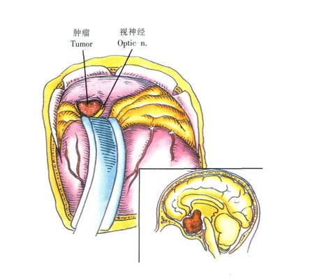 经额叶入路垂体腺瘤切除术 神经外科手术彩色图谱