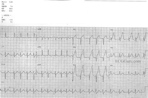 Anterior Wall Mi With Atrial Fibrillation Ecg Guru Instructor