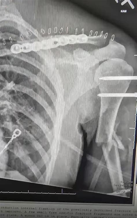 Girl Wrecks Car And Hangs From Telephone Wire Survies Rnsfl