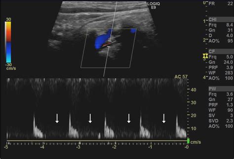 Doppler Sonography Showing The Waveform For Blood Flow In The Right