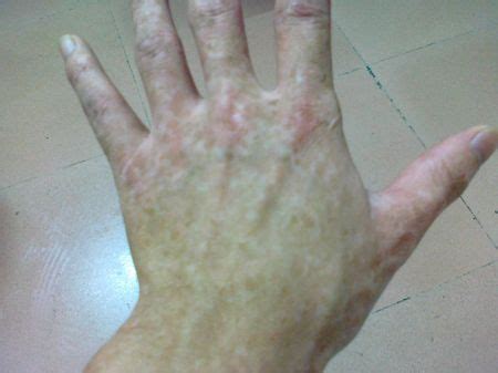 手背色素沉着图片 手上出现褐色的斑图片 伤感说说吧