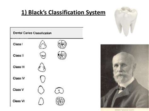 Classification Of Dental Caries Rasha Adel Copy