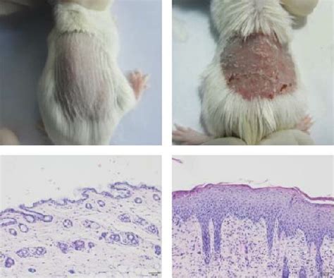 Serpinb3a Is Highly Expressed In Imiquimod Imq Induced Psoriasis Like