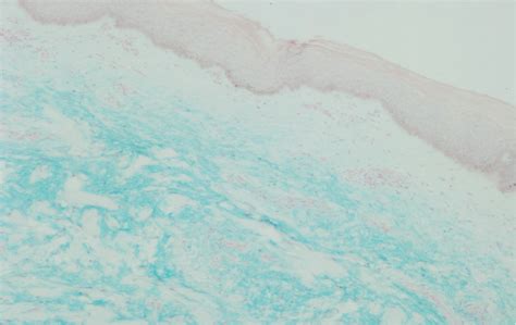 Current Insights On Treating Graves Dermopathy In The Foot