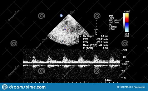 Pulse Wave Doppler Ultrasound Examination Stock Image 166874071