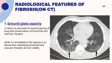 Radiological Imaging Of Collapse Vs Consolidation Vs Fibrosis Pptx
