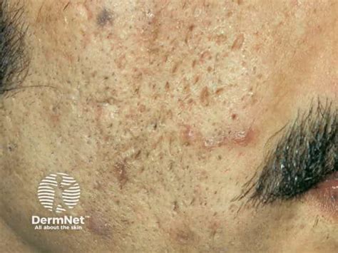 Acne Scarring Images — Dermnet