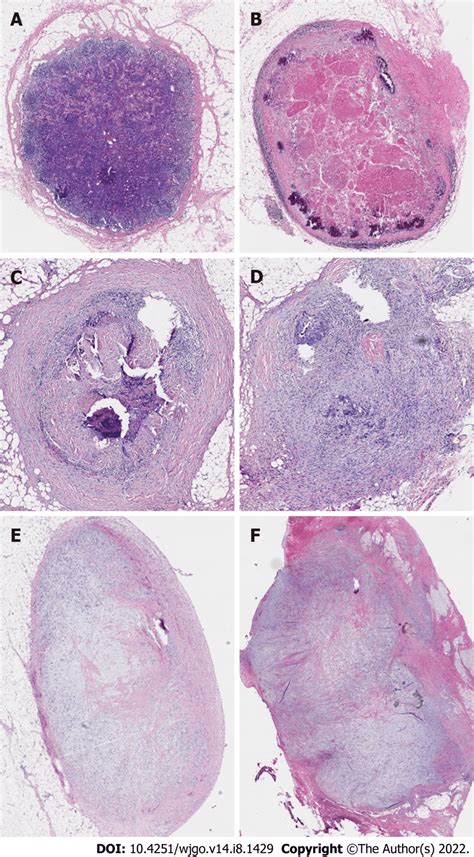 examples of lymph node regression grades according to mirbagheri et