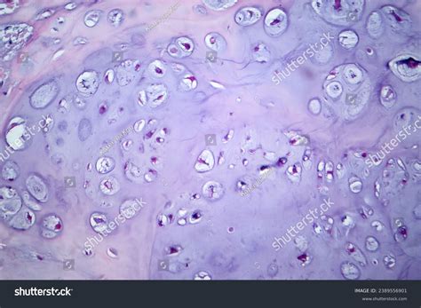 Photomicrograph Chondrosarcoma Malignant Cartilage Tumor Revealing