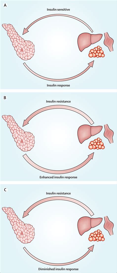 Type 2 Diabetes Pathophysiology Diagram