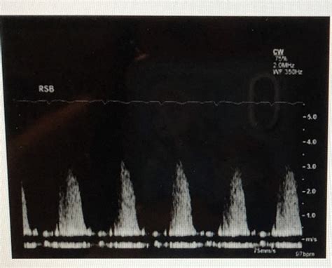 ECHO Questions Flashcards Quizlet