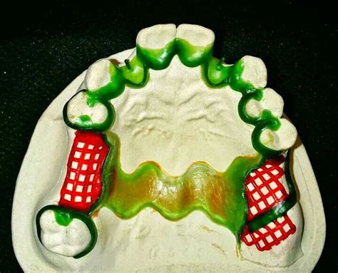 Removable Partial Denture Design Artofit