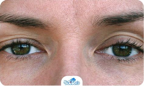 افتادگی پلک چیست؟ علت و پیشگیری بهترین روش های درمان