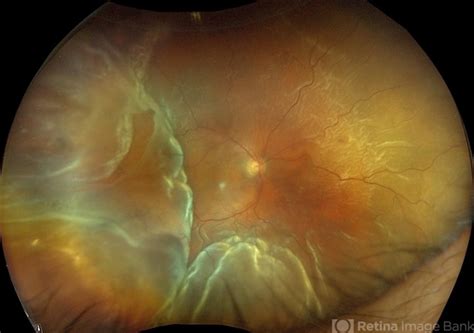 Total Retinal Detachment Retina Image Bank