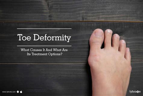 Toe Deformity What Causes It And What Are Its Treatment Options By