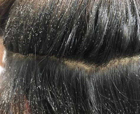 Try These Easy Home Remedies To Get Rid Of Lice Eggs Herzindagi