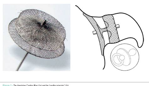 Figure 1 From Left Atrial Appendage Closure With The Amplatzer Cardiac Plug In Patients With