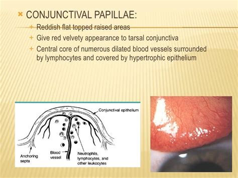 Conjunctiva And Its Disorders