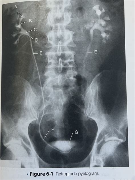 Label Retrograde Pyelogram Diagram Quizlet