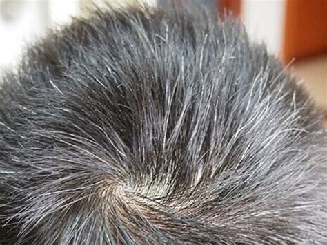 少白头到底是什么造成的？能治疗么