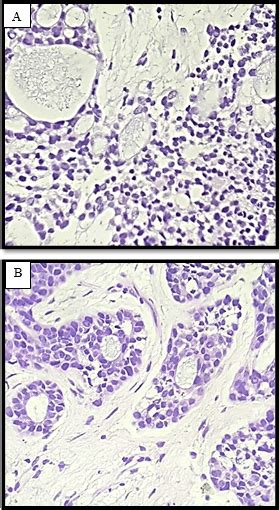 A And B 400x Moderately Uniform Cells With Hyperchromatic Nuclei And