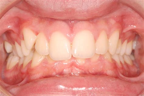 Orthodontic Treatment Without Extractions Ορθοδοντικός στην Κέρκυρα
