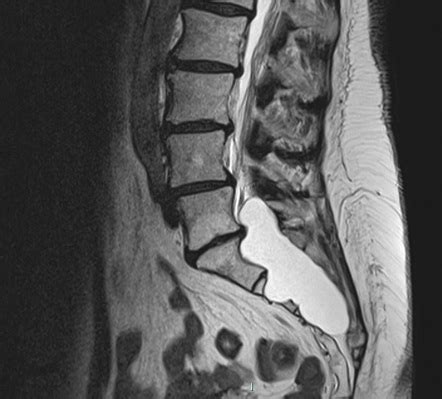 Tarlov Cyst Sacral Canal