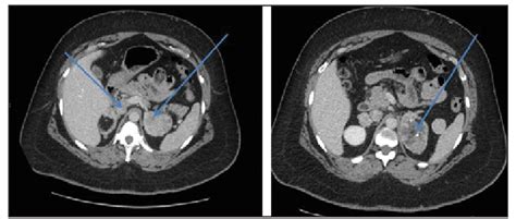 Hypertrophy Of Both Adrenal Glands With A Nodule In The Lateral Limb Of