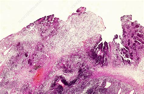 Paediatric Rhabdomyosarcoma Light Micrograph Stock Image C053 8949 Science Photo Library