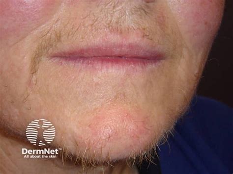 Hirsutism Excessive Hair In Females