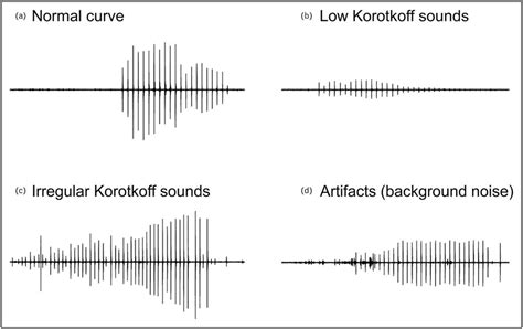 Visual Assessment Of Korotkoff Sounds Improves The Accuracy
