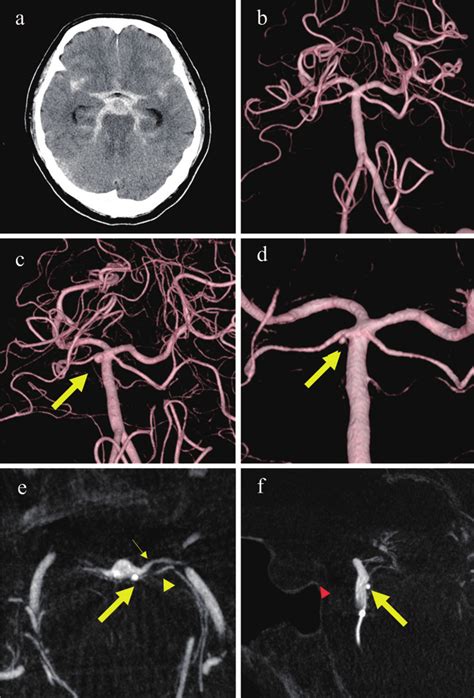 A Head Ct Scan Demonstrated Diffuse Sah In The Perimesencephalic Download Scientific Diagram