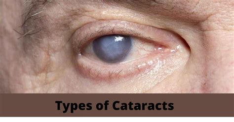 Different Types Of Cataracts Signs Causes And Ways To Prevent Different Types Of Cataracts Signs Causes And Ways To Prevent