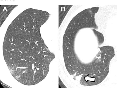 Figure 1 From Multimodal Indirect Imaging Signs Of Pulmonary Embolism Semantic Scholar