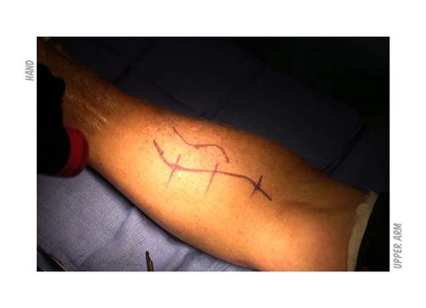 Median Nerve Forearm Decompression Surgical Education Learn Surgery Washington University