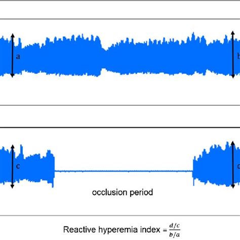 A Representative Reactive Hyperemia Arterial Tonometry Recording Of A Download Scientific