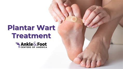 Plantar Wart Treatment Ankle And Foot Centers Of America