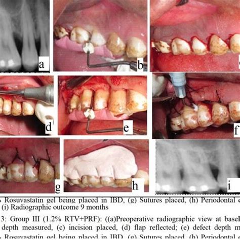 Comparative Evaluation Of Papillary Bleeding Index Download Scientific Diagram