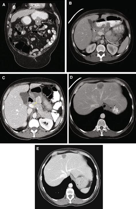 Gastrointestinal Stromal Tumors Gists A Gastric Gist With