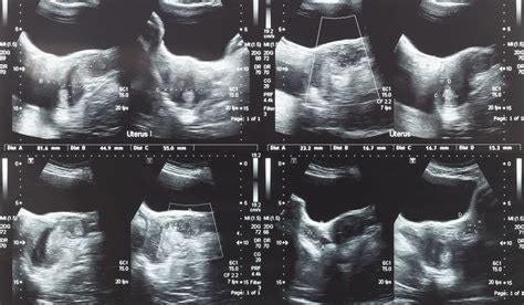 Surgery For Uterine Fibroids Minimizing Risk Vanderbilt Discover