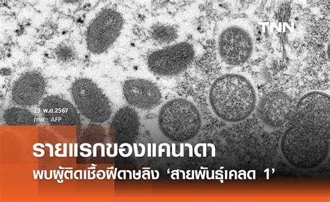 รายแรก แคนาดา ยืนยันพบผู้ติดเชื้อโรคฝีดาษลิง สายพันธุ์เคลด 1