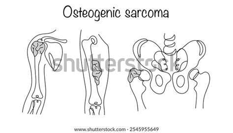 30 Osteogenic Sarcoma Stock Vectors And Vector Art Shutterstock