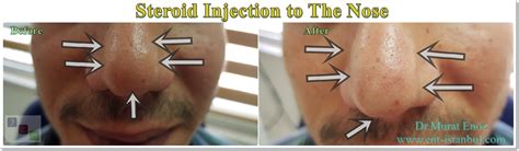 Steroid Injection After Rhinoplasty