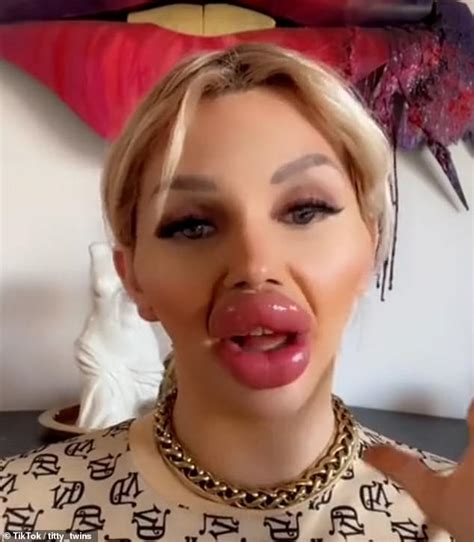 Ive Had So Much Lip Filler I Have Trouble Breathing And Cant Close My