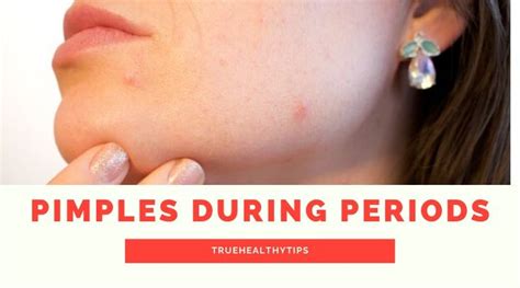 Why Do Acne During Periods Every Other Month How To Get Rid Of Acne Acne Coconut Oil Lotion